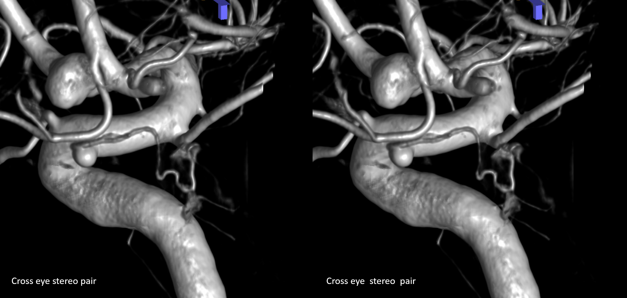Superior Hypophyseal Artery
