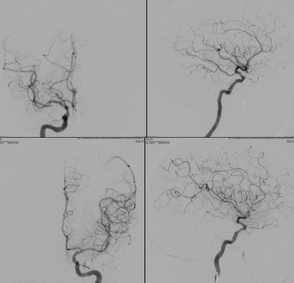 Cone Beam CT Philips Stents for ICAD Basilar Occlusion Vasa Vasorum 1 ...