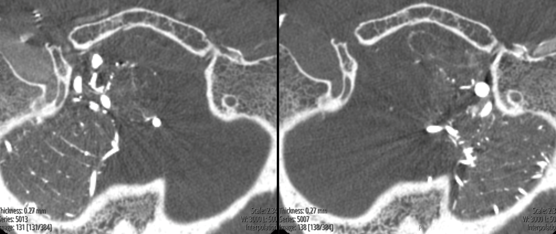 Cone Beam CT Philips Stents for ICAD Basilar Occlusion Vasa Vasorum 1 ...