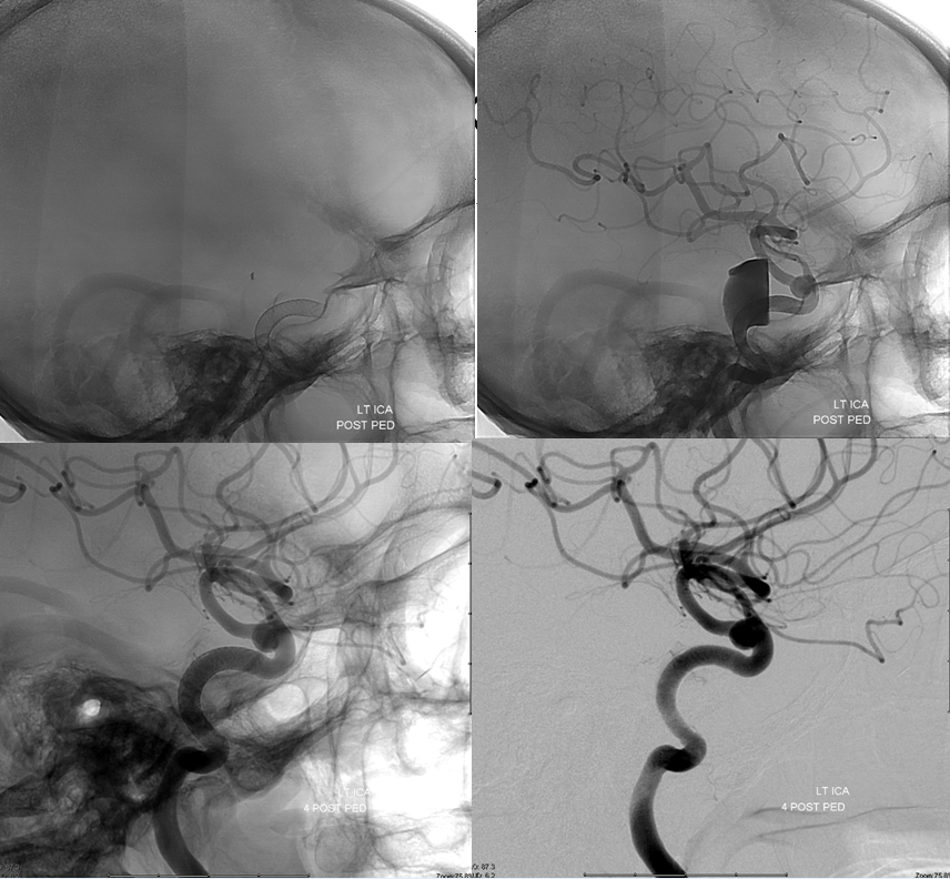 Anterior Cerebral Artery | neuroangio.org