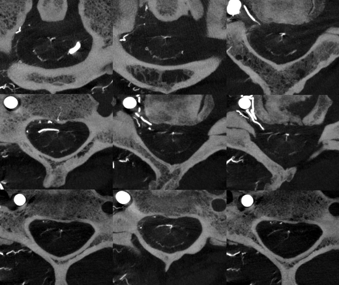 Spinal Venous Anatomy | neuroangio.org