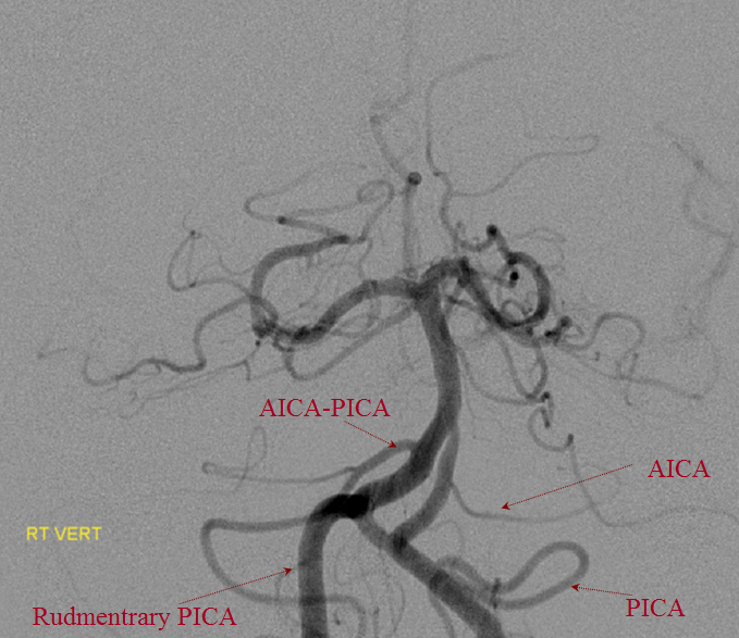 Basilar Artery | neuroangio.org