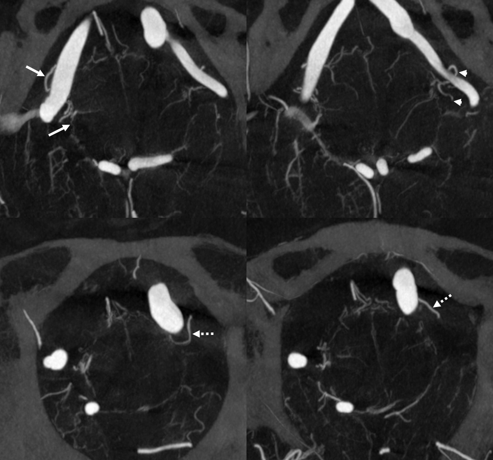 Vertebral Artery | neuroangio.org